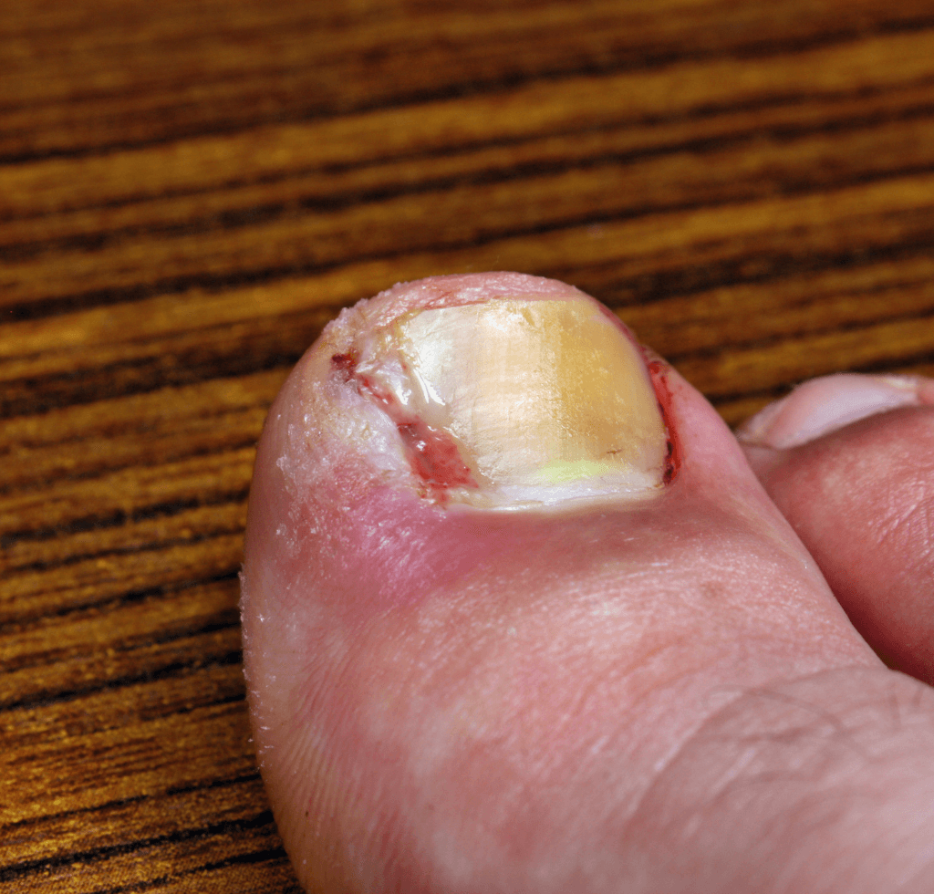 10 Alarming Signs Of Diabetes Foot Complications Diabetes Fixer