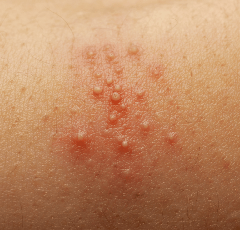 13 Surprising & Common Skin Indicators of Diabetes - Diabetes Fixer