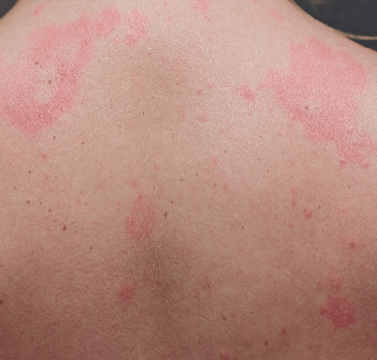 13 Surprising & Common Skin Indicators of Diabetes - Diabetes Fixer