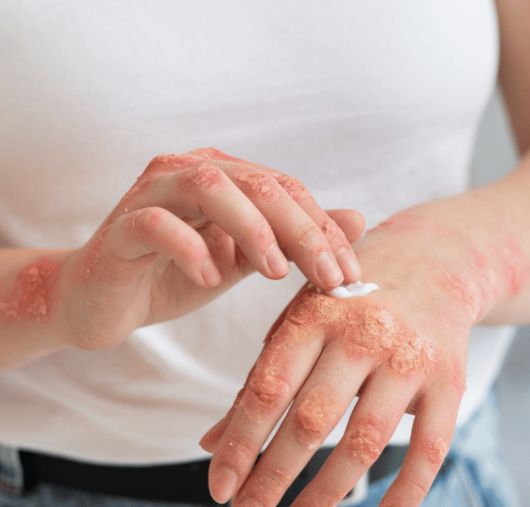 13 Surprising & Common Skin Indicators of Diabetes - Diabetes Fixer