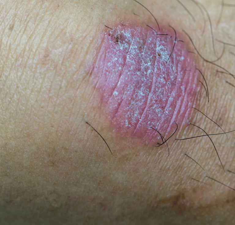 13 Surprising & Common Skin Indicators of Diabetes - Diabetes Fixer