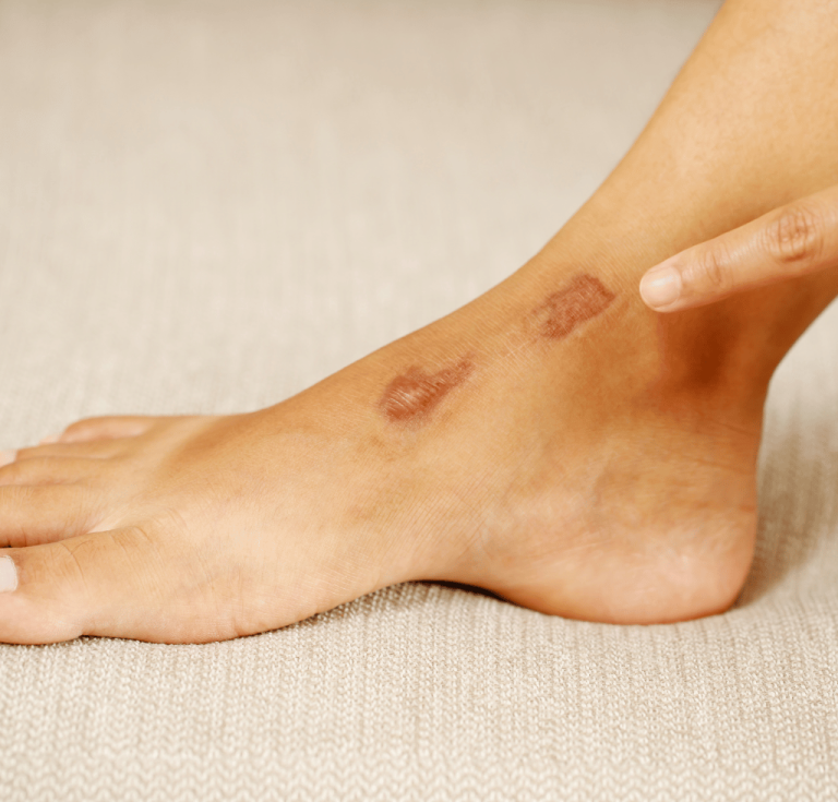 13 Surprising & Common Skin Indicators of Diabetes - Diabetes Fixer